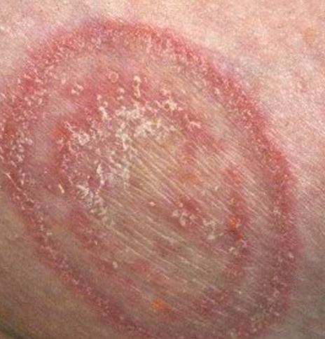 Rash on Inside of Thigh: Near Groin, Buttocks, Symptoms, Causes, STD ...