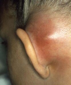 Lump behind Ear: Causes, Symptoms, on Neck, Piercing, Mastoiditis ...