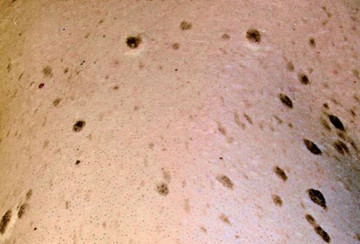 skin-colored-mole-on-arm - Treat MD