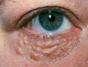 Bumps under Eyes, Meaning, Milia Dots, Causes, Hard, Cholesterol Dots ...