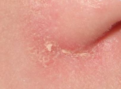 Itchy Nose, Meaning, Tip, Allergy, Treatment & Home Remedy - Treat MD