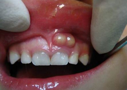 Gum Boil, Abscess, Causes, Meaning, Pictures, Symptoms, No Pain ...