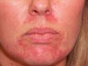 Rash on Nose, around Mouth, Upper Lips, Dry Skin, Causes, Won’t Go Away ...