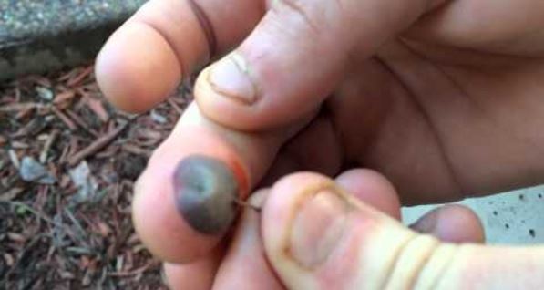 Blood Blister on Finger, Nail, Causes, Pictures, Hurts, Infected, Small ...