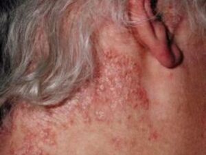 Rash Behind Ear, Neck, Causes, Itchy, Symptoms, Pictures, Small Bumpy ...
