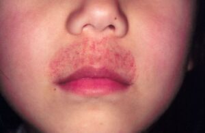 Rash on Nose, around Mouth, Upper Lips, Dry Skin, Causes, Won’t Go Away ...