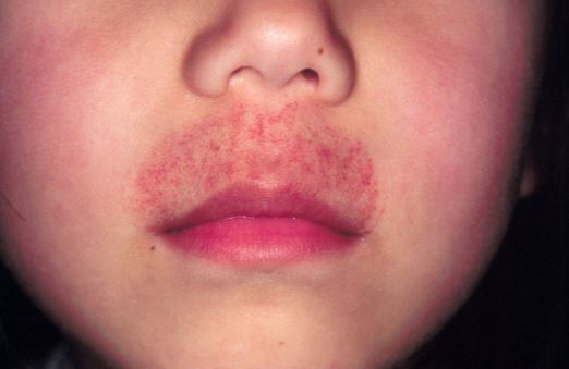 Rash on Nose, around Mouth, Upper Lips, Dry Skin, Causes, Won’t Go Away ...
