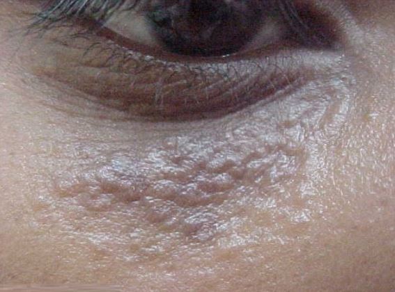 Bumps under Eyes, Meaning, Milia Dots, Causes, Hard, Cholesterol Dots ...