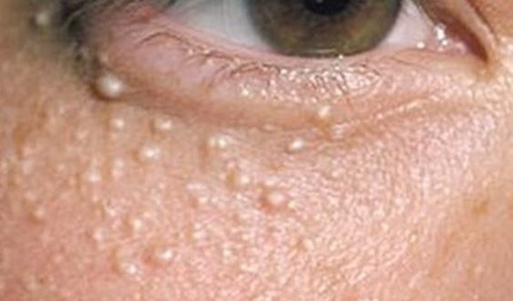 Bumps Under Eyes Meaning Milia Dots Causes Hard Cholesterol Dots Pictures Skin Colored