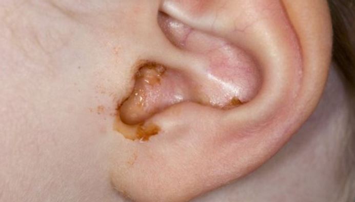 Itchy Ear Canal, Causes, Eczema, Wax, At Night, How to Relieve, Treat ...