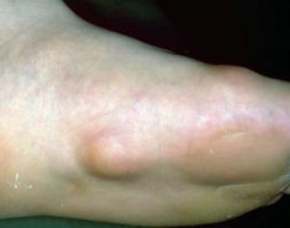 Bumps on Bottom of Feet, Red, White, Small, Painful, Hurt, That Itch ...