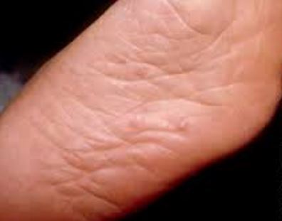 Bumps on Bottom of Feet, Red, White, Small, Painful, Hurt, That Itch ...