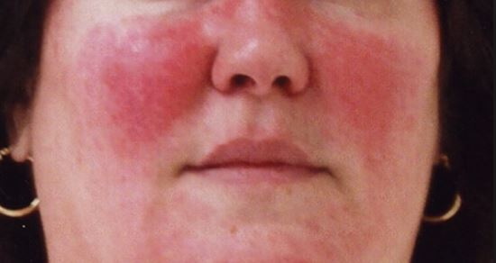 Redness Around Nose Cheeks Mouth Causes Pictures Get Rid Toddler redness-around-nose-cheeks-mouth-causes-pictures-get-rid-toddler