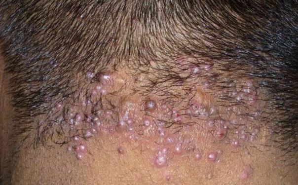 Itchy Bumps on Scalp, Neck, Causes, Red, Hurts, Pictures, Raised, Small ...