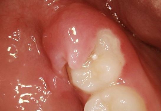 Swollen Gums, around Wisdom Tooth, Causes, Symptoms, Pregnancy, Sore ...