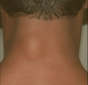 Lump on Back of Neck, Hairline, under Skin, Right Side, Left, Near ...