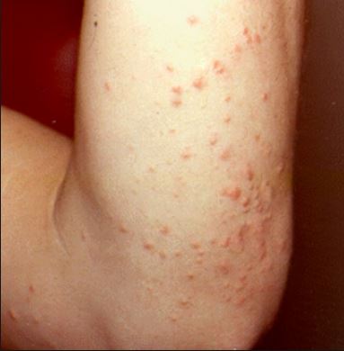 Bumps on Elbows, Knees, Causes, Raised, Little, White, Red, Pictures ...