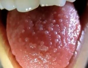 Swollen Taste Buds, Inflamed, Causes on Sides, Tip, Under and on Back ...
