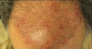 Infected Hair Follicle, Picture, Treatment, Removal, Home Remedy – Treat MD
