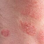 Red Patches on Skin, Causes, Pictures & Treatment – Treat MD