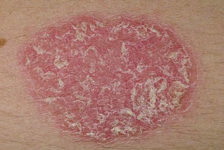 Red Patches on Skin, Causes, Pictures & Treatment – Treat MD