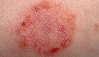 Red Patches on Skin, Causes, Pictures & Treatment – Treat MD