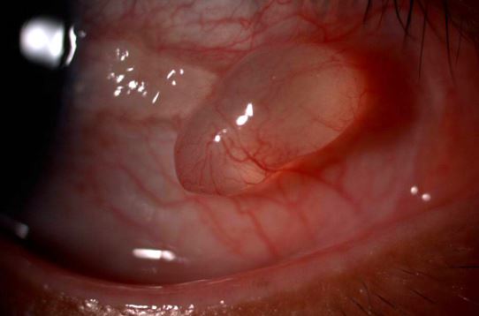 Cyst On Eyeball Inside Behind Causes Pictures Dermoid Small Clear