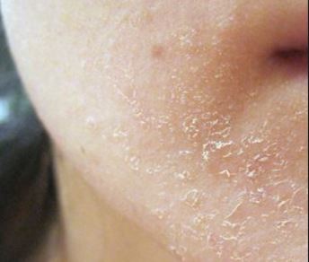 Dry Skin on Face, Forehead, Causes, Scalp, Hairline, Very Dry, on Baby ...