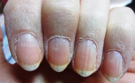 Dry Skin around Nails, Vitamin Deficiency, Hard, Peeling Skin, Causes ...