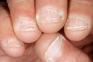 Dry Skin around Nails, Causes, Vitamin Deficiency, Cure & Remedy – Treat MD