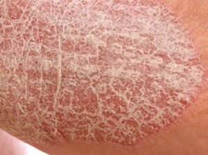 Dry Skin on Legs, Pictures, Scaly, Snakeskin – Like, Flaky, Diabetes ...