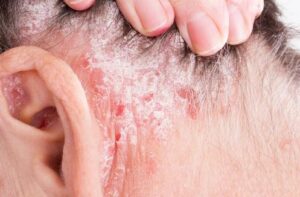 Dry Skin behind Ear, Cracked Skin, Baby, Causes, Psoriasis, Itchy ...