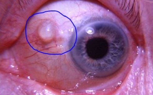 Cyst on Eyeball, Inside, behind, Causes, Pictures, Dermoid, Small Clear ...
