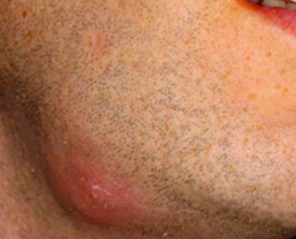 Lump under Chin, Bone, Near Throat, Neck Cancer, Cold Sore, Right or ...