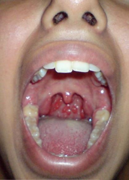 Lump In Back Of Throat Feeling Hard Large Lump Behind Uvula Near Tonsil Right Side Left