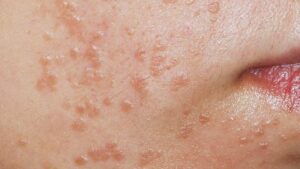 Flat Warts on Face, Pictures, Removal, Treatment, Causes, How to Get ...