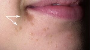 Flat Warts on Face, Pictures, Removal, Treatment, Causes, How to Get ...