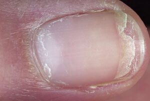 Nail Splitting, Cracked, Causes, Vitamin Deficiency, Vertically ...