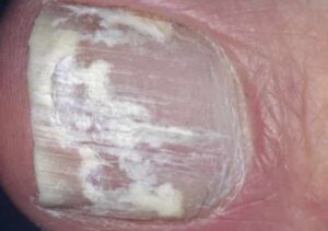 White Spots on Toenails, Meaning, Pictures, Fungus, Get Rid, Home ...