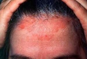 Shingles on Scalp, Symptoms, Pictures, No Rash, Swollen Lymph Nodes ...